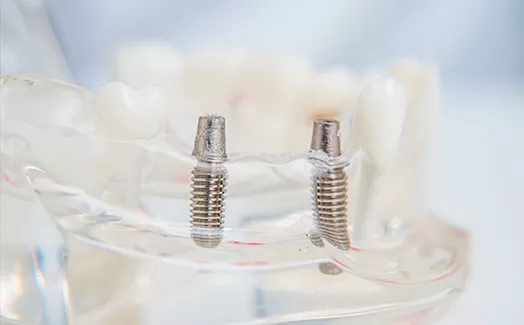 Life-changing dental implant procedures here in Sparks | Wildcreek Dental